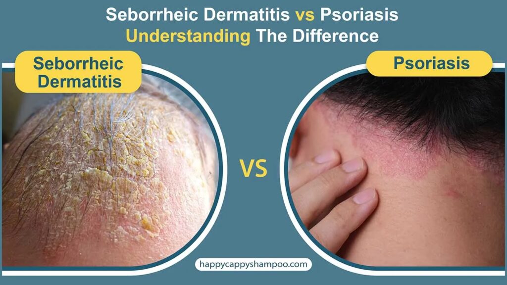 Psoriasis vs. Psoriasiform Dermatitis: Forskellen - MEDNOTE