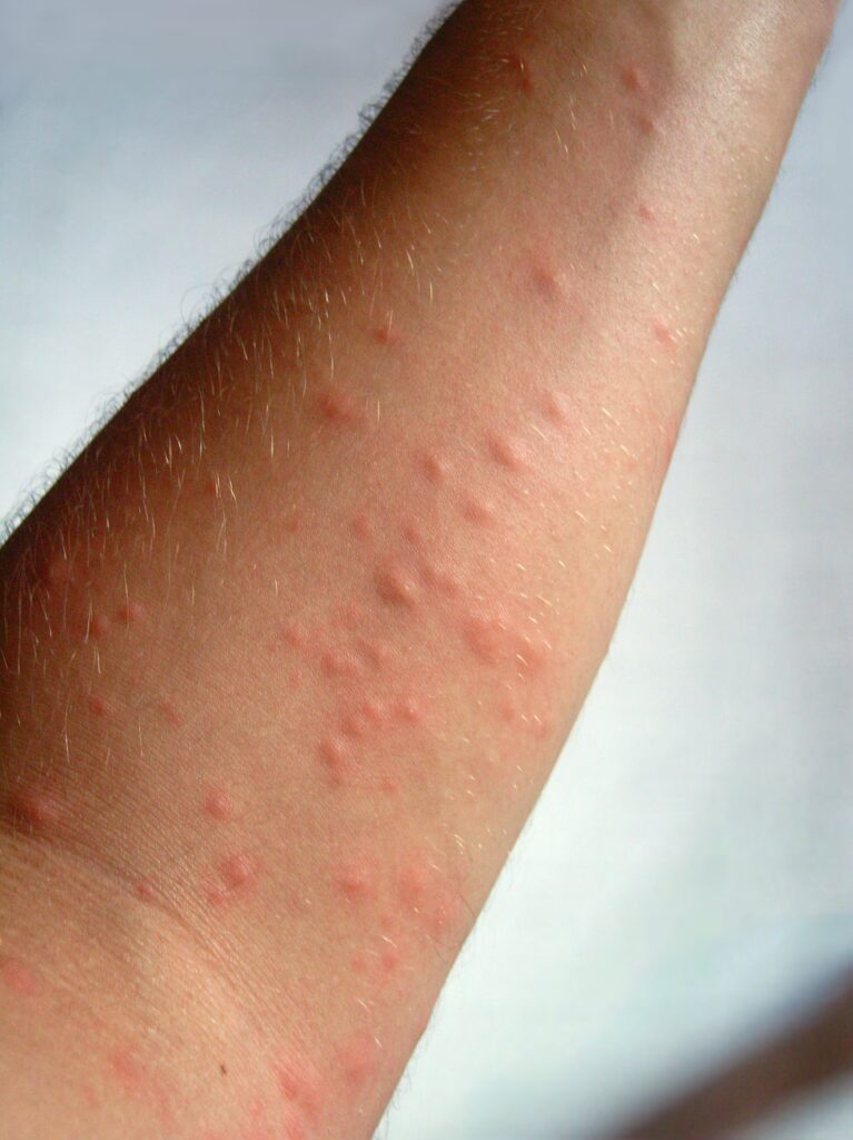 Egeprocessionsspinder: Symptomer og Behandling - MEDNOTE