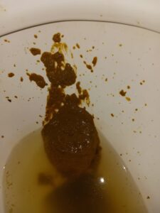 Eksplosiv Diarré: Årsager og Naturlig Behandling - MEDNOTE