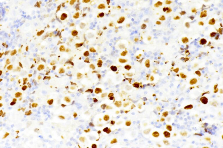 HHV-8: Fra Virus til Lymfom hos Patienter - MEDNOTE