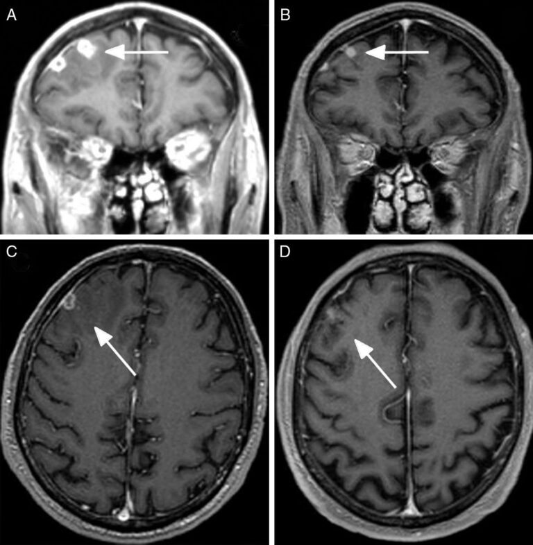 Negativ Tuberkulintest: Hvad betyder det? - MEDNOTE