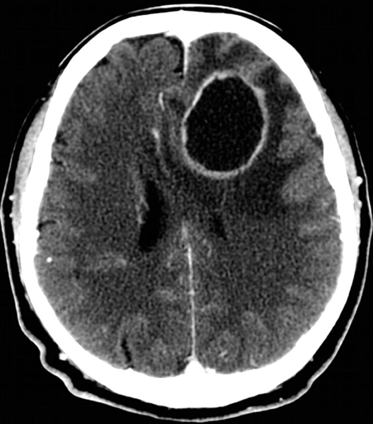 Negativ Tuberkulintest: Hvad betyder det? - MEDNOTE