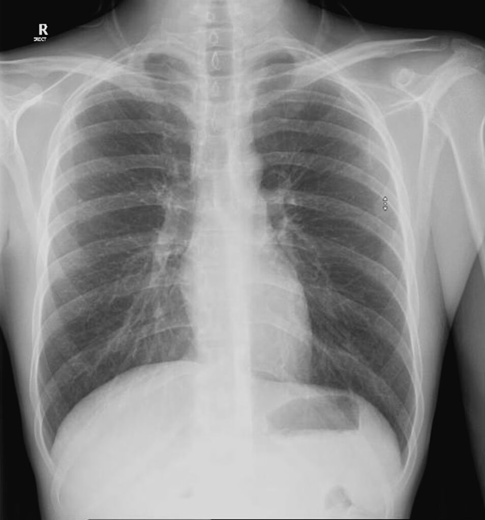 Tuberkulose i Spytkirtlen: En Sjælden Diagnose - MEDNOTE